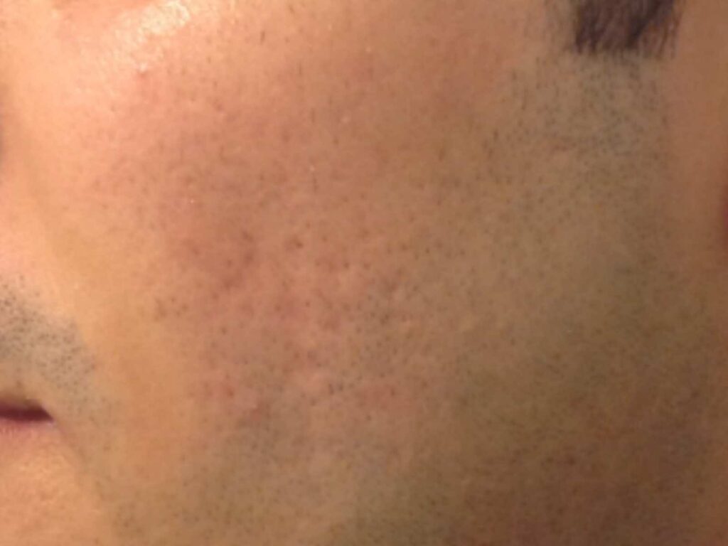 CUTERA | Secret™ DUO