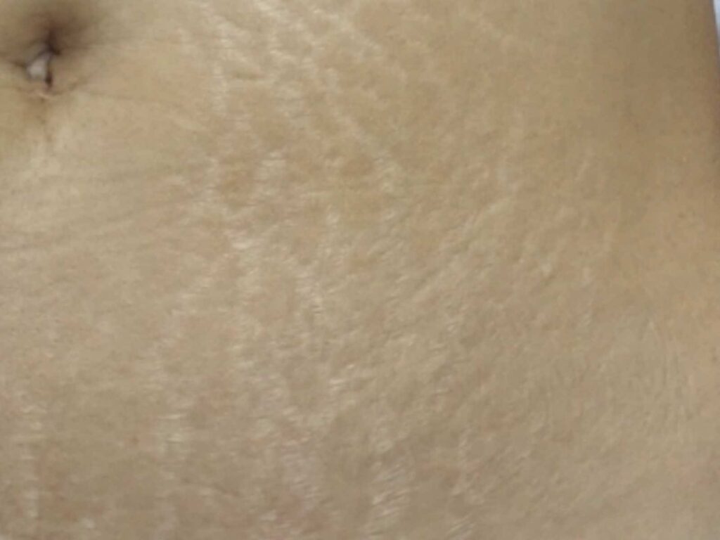 CUTERA | Secret™ DUO