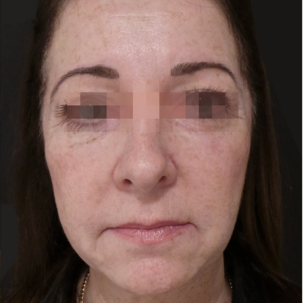 CUTERA | Treatments for Younger-Looking Skin