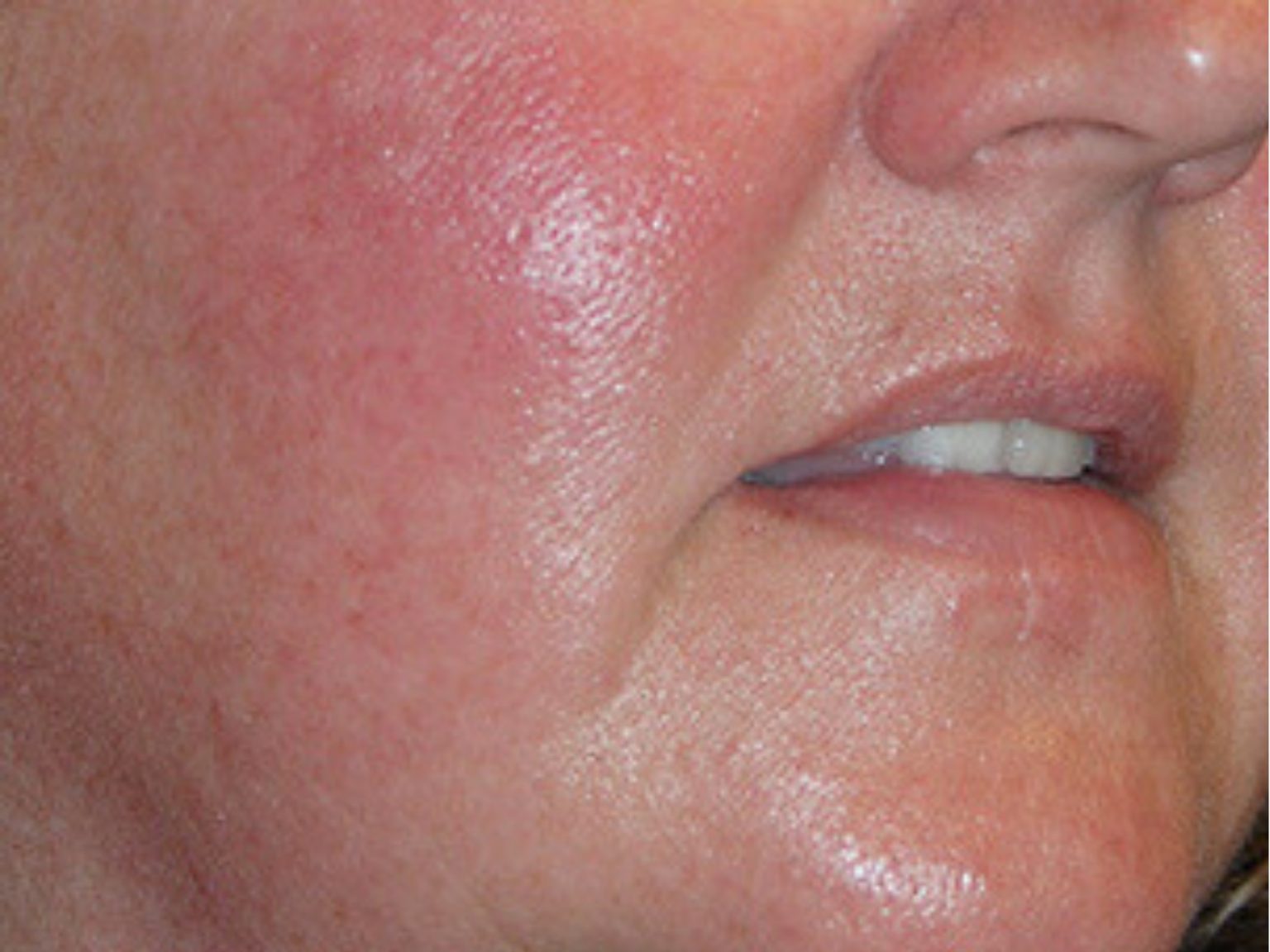CUTERA | Laser Genesis™